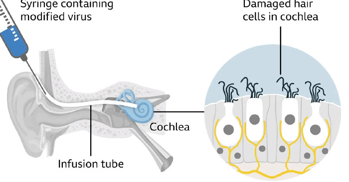 Kochleární implantát :: Dolník